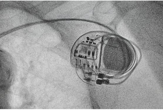 The Shocking truth about breast implants, prostheses, and pacemakers